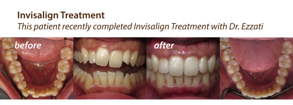 Your 'Invisalign Near Me' Provider | Olympic Village Dental