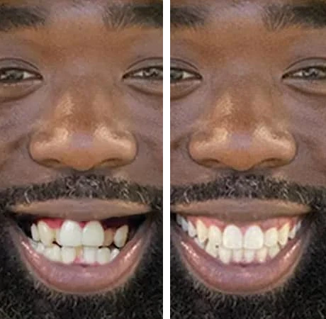 Invisalign Day - October 2025 - Olympic Village Dental